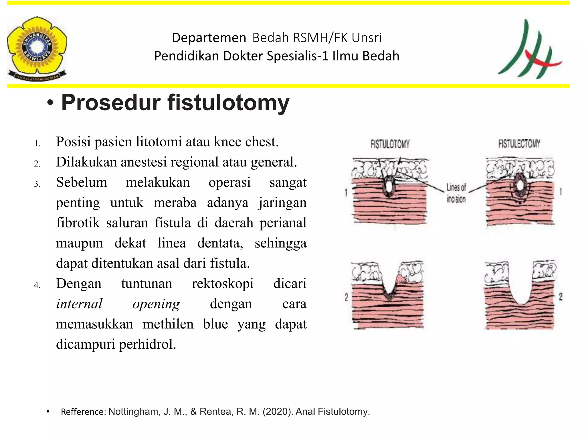 fistulotomy BAY.pptx