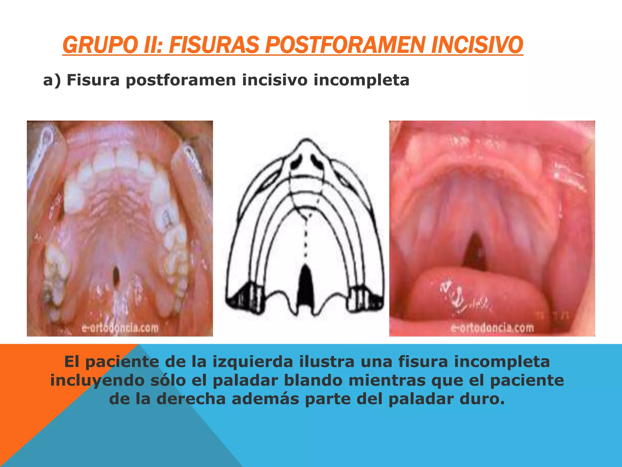 Fisura labio- naso- alveolo palatina | PPTX
