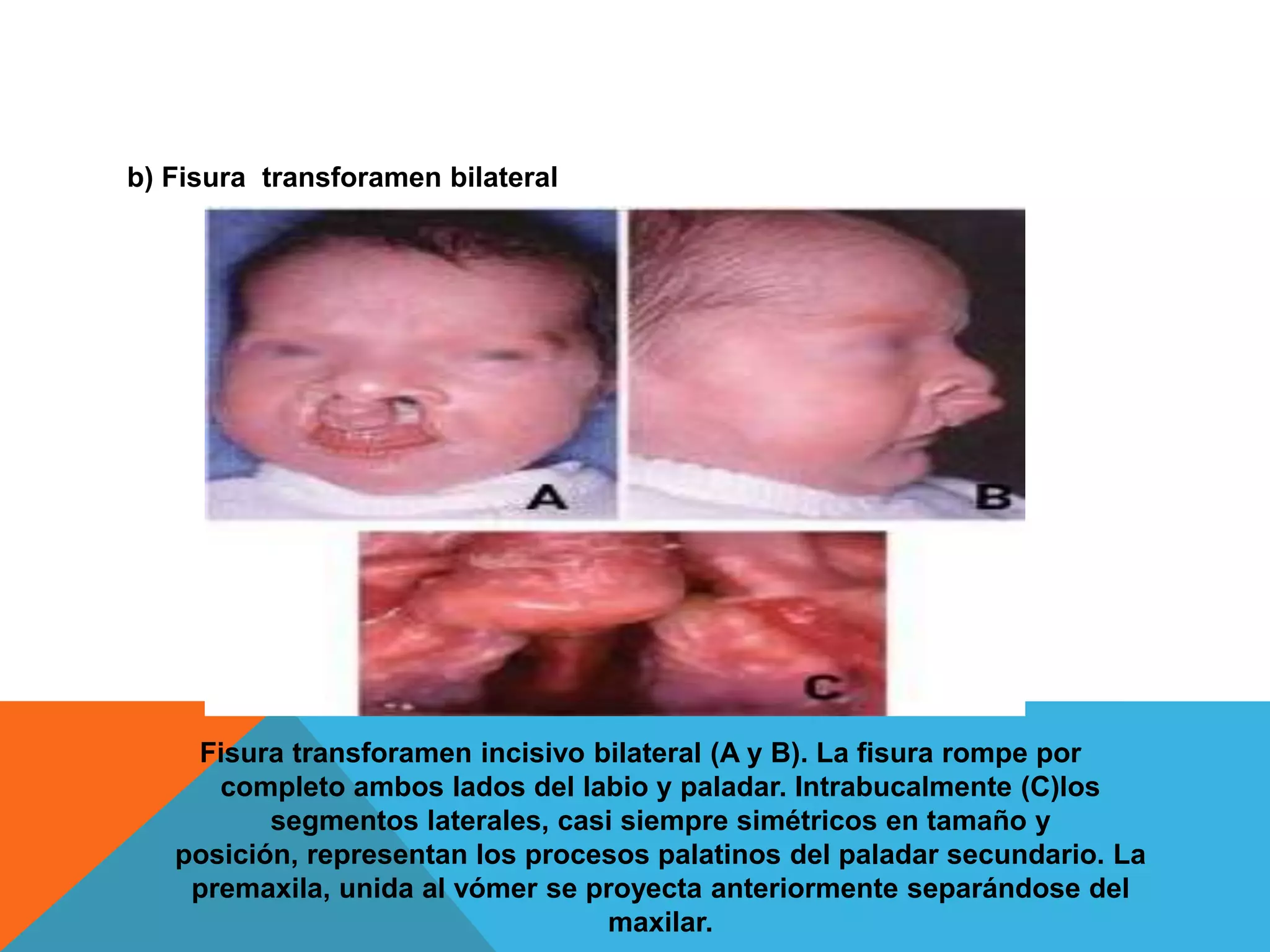 Fisura labio- naso- alveolo palatina | PPTX