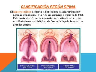 Fisura labio- naso- alveolo palatina | PPTX