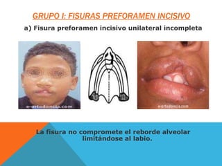 Fisura labio- naso- alveolo palatina | PPTX