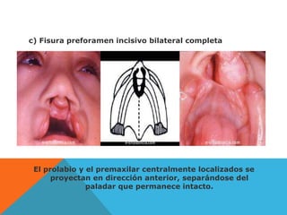 Fisura labio- naso- alveolo palatina | PPTX
