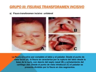 Fisura labio- naso- alveolo palatina | PPTX