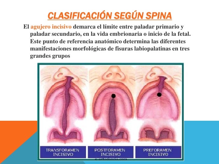 Fisura labio- naso- alveolo palatina