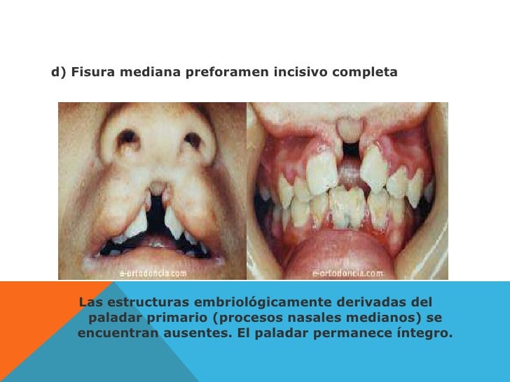 Fisura labio- naso- alveolo palatina