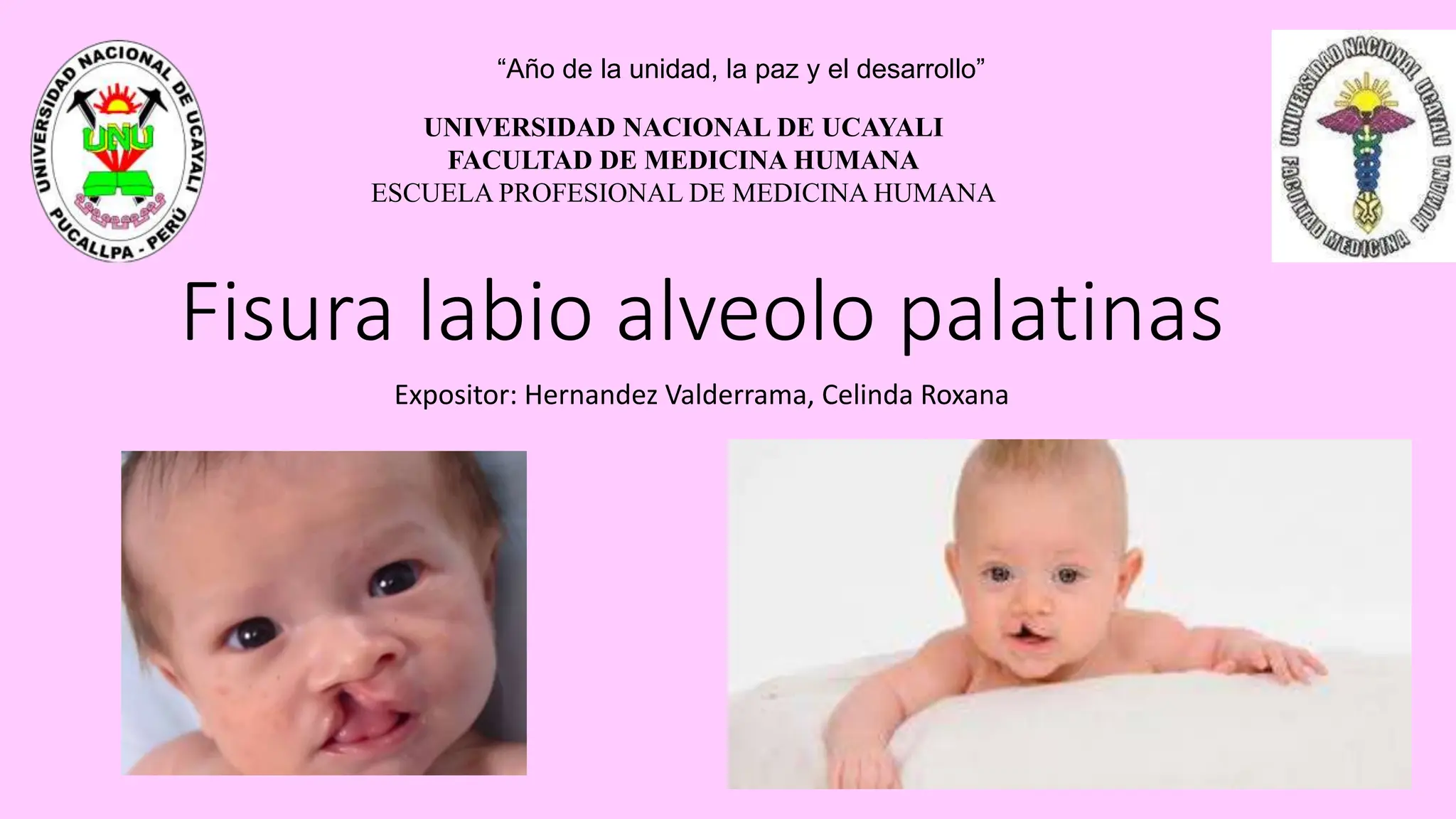 tema: Fisura labio alveolo - palatina.pptx