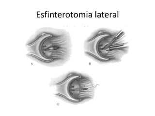 Fisura anal | PPTX