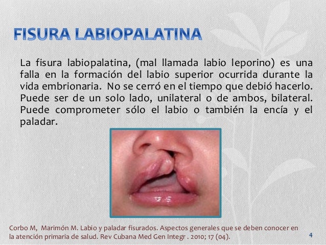 Tessier Fissura Labiopalatina