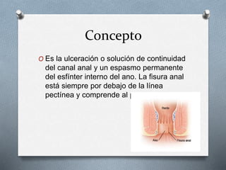 Fisuras y fistulas anales marcos montero-7-792-2392 | PPTX