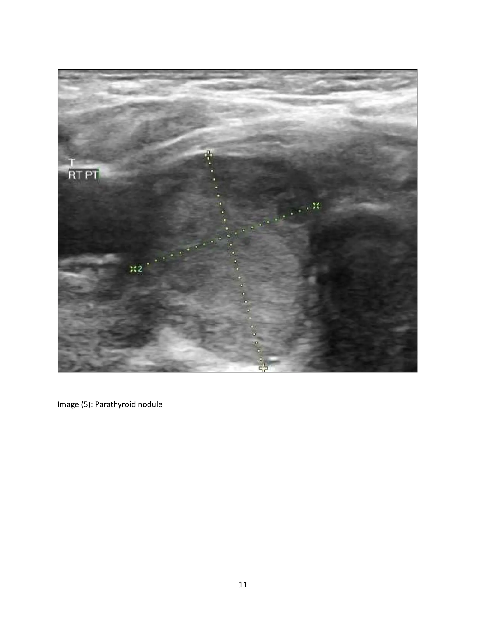 Uremic Leontiasis Ossea | DOCX