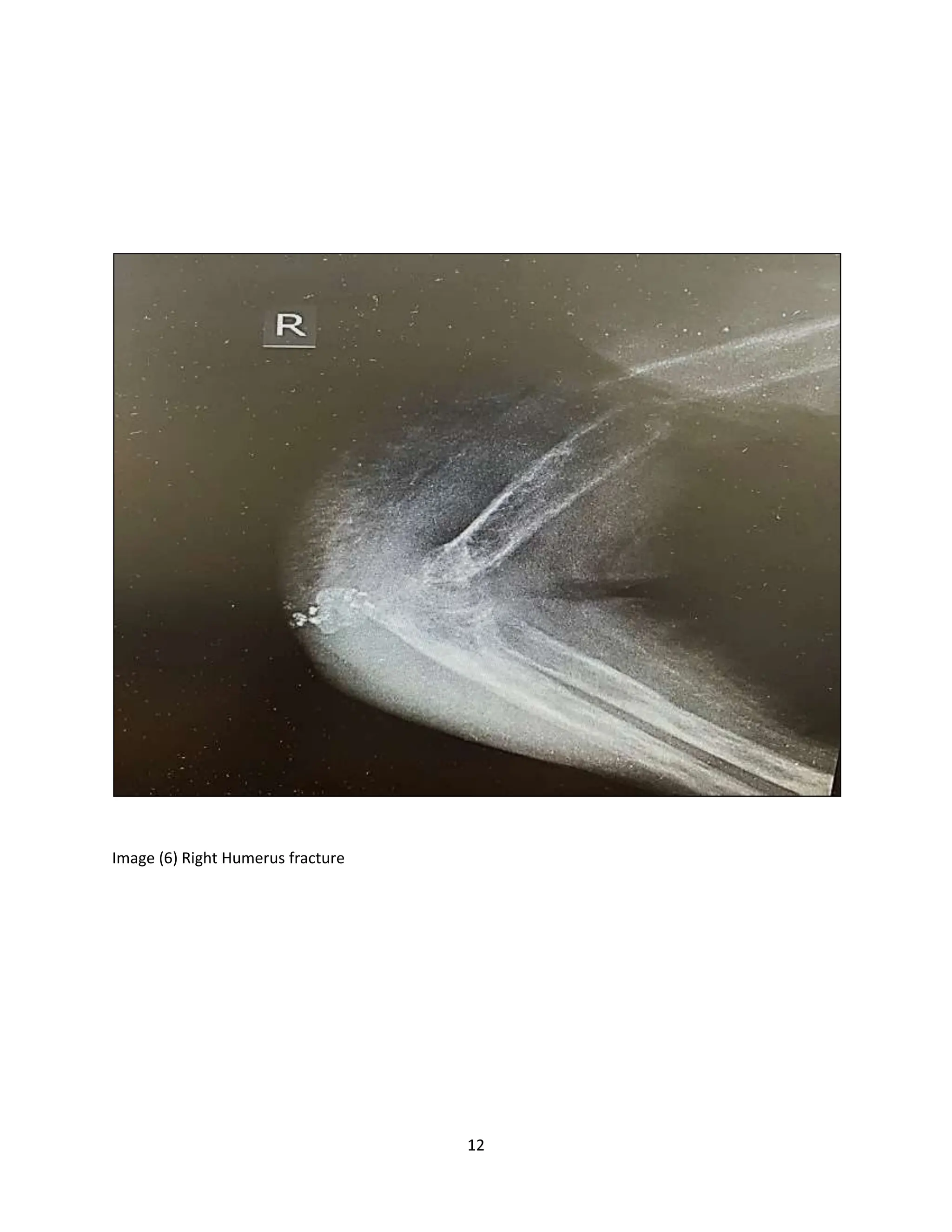 Uremic Leontiasis Ossea | DOCX