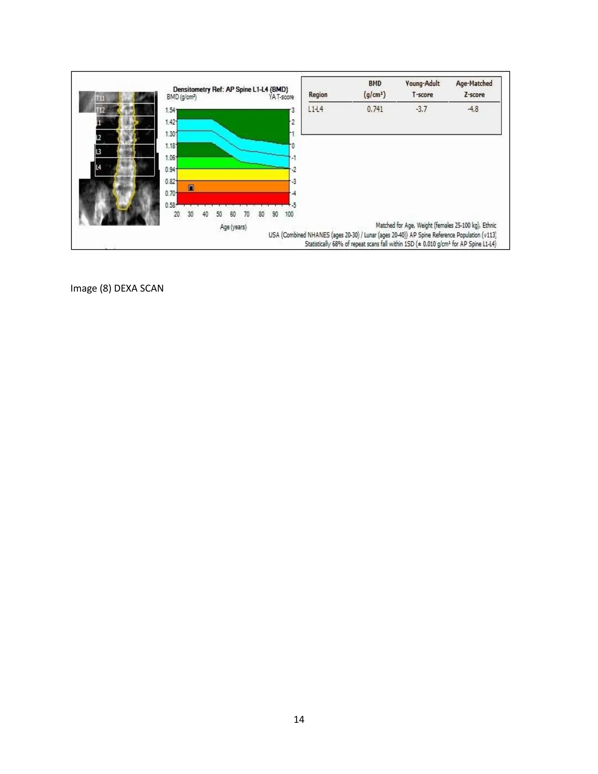 Uremic Leontiasis Ossea | DOCX