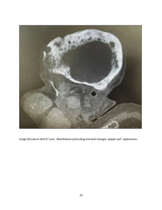 Uremic Leontiasis Ossea | DOCX