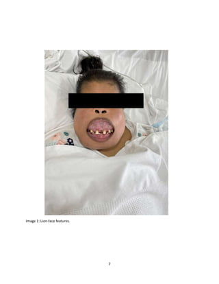 Uremic Leontiasis Ossea | DOCX