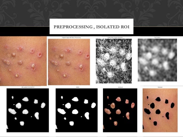 Skin Disease Classification