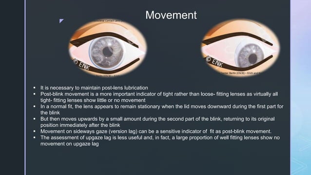Fitting assessment of soft contact lens | PPTX