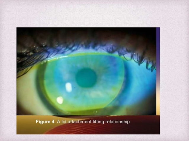 Fitting Philosophies and Assessment of Spherical RGP lenses | PPT