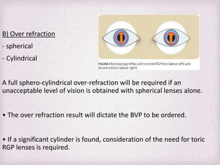 Fitting Philosophies and Assessment of Spherical RGP lenses | PPTX