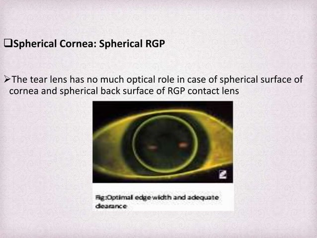 Fitting Philosophies and Assessment of Spherical RGP lenses | PPTX ...
