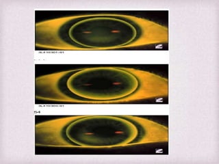 Fitting Philosophies and Assessment of Spherical RGP lenses | PPTX