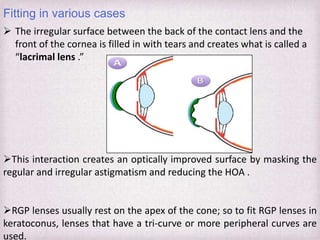 Fitting Philosophies and Assessment of Spherical RGP lenses | PPTX