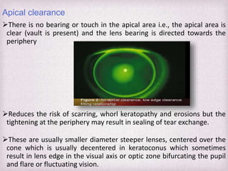 Fitting Philosophies and Assessment of Spherical RGP lenses | PPT