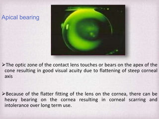 Fitting Philosophies and Assessment of Spherical RGP lenses | PPT