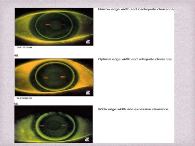 Fitting Philosophies and Assessment of Spherical RGP lenses