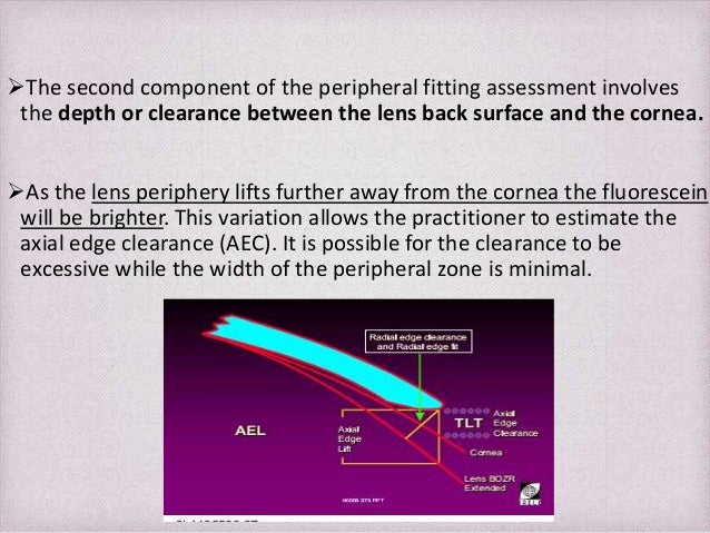 Fitting Philosophies and Assessment of Spherical RGP lenses
