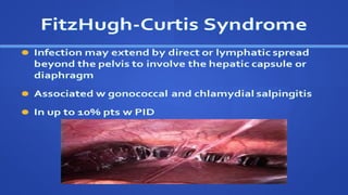 fitz hugh curtis 症候群 – fitz hug curtis症候群 – SKLF