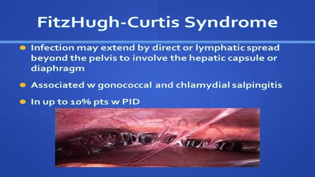 Fitz Hugh Curtis Syndrome