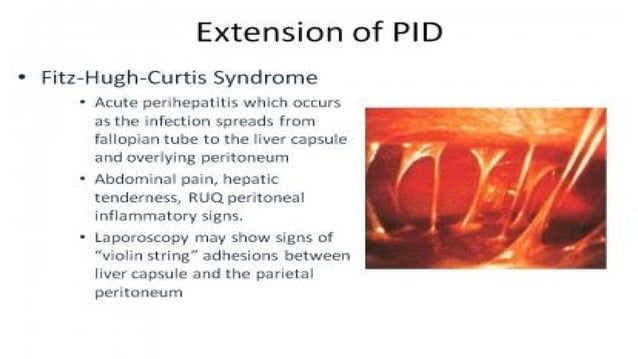 Fitz Hugh Curtis Syndrome | PPT