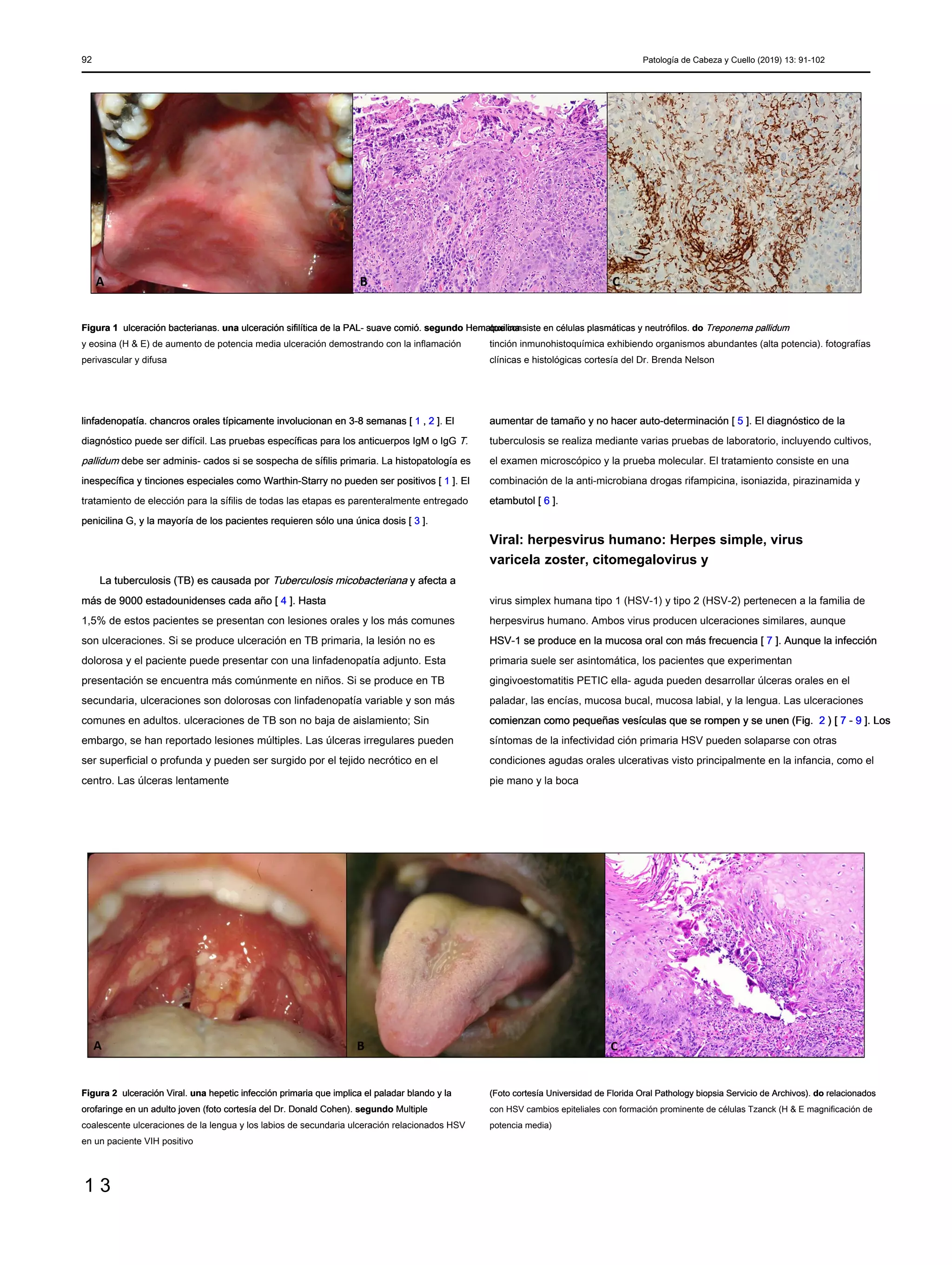 Las lesiones ulceradas de la mucosa oral: revisión clínica e ...