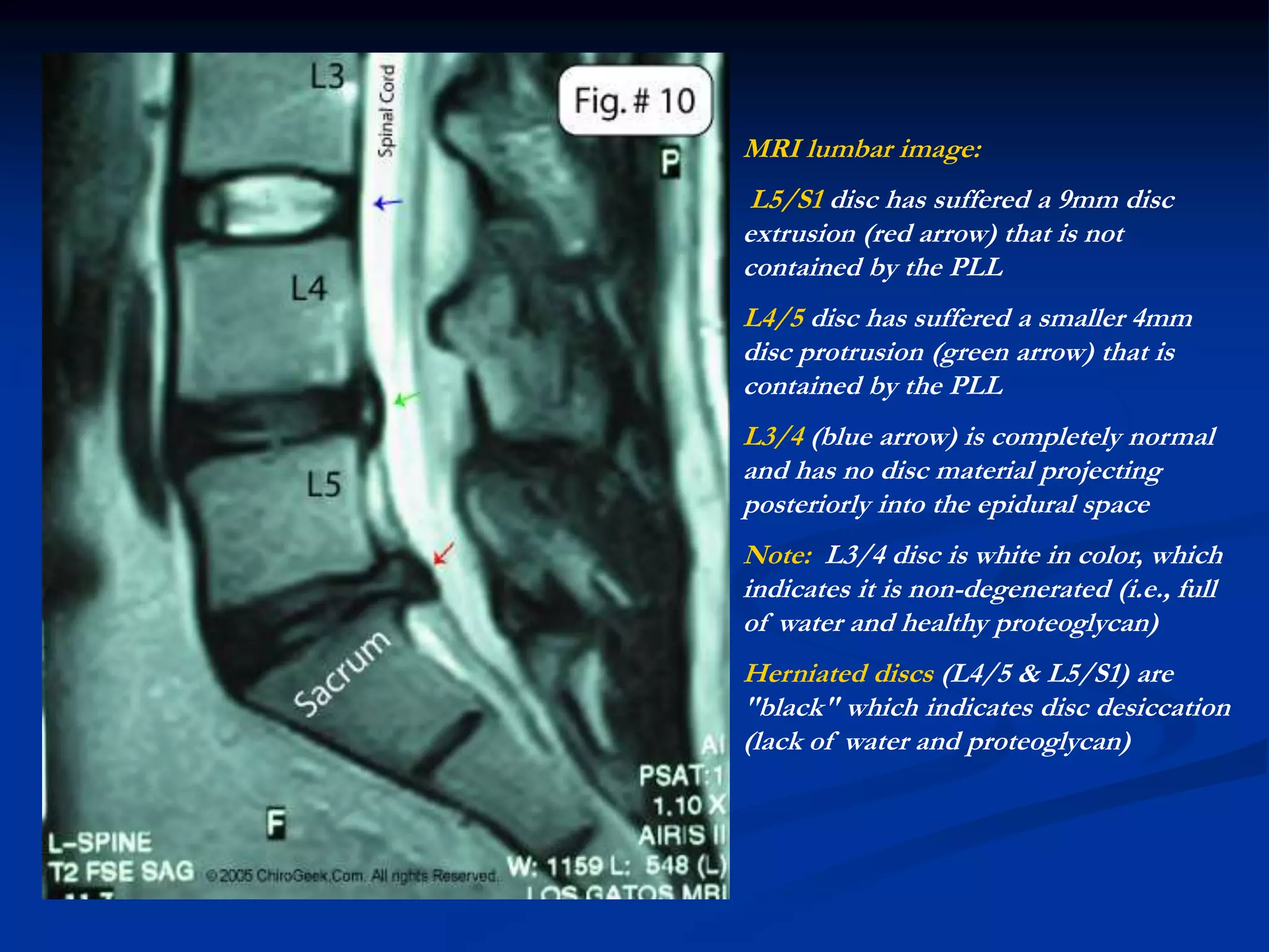 _FIU - Thoracic and Lumbar Spine Special Tests and Pathologies (1 ...