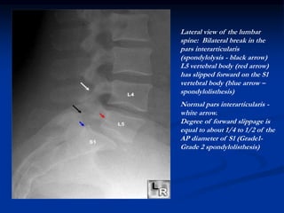 _FIU - Thoracic and Lumbar Spine Special Tests and Pathologies (1 ...