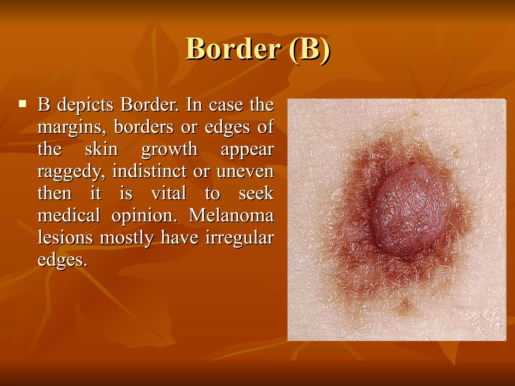 Five Signs Of Skin Cancer At