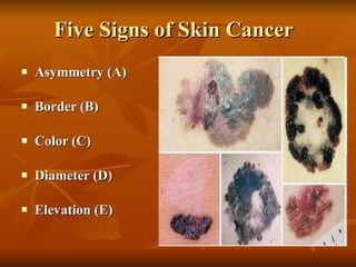 Five Signs Of Skin Cancer at Justcancer.org