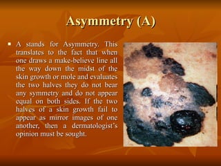 Five Signs Of Skin Cancer at Justcancer.org