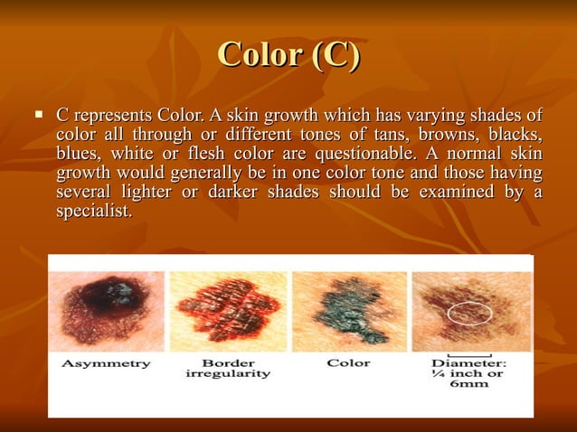 Five Signs Of Skin Cancer at Justcancer.org
