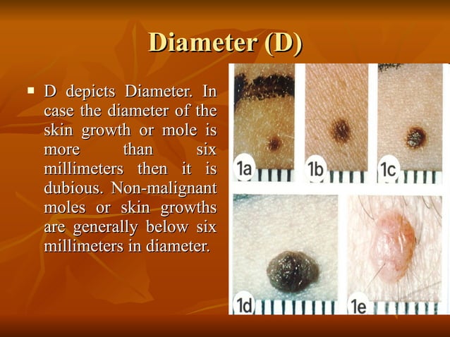 Five Signs Of Skin Cancer at Justcancer.org
