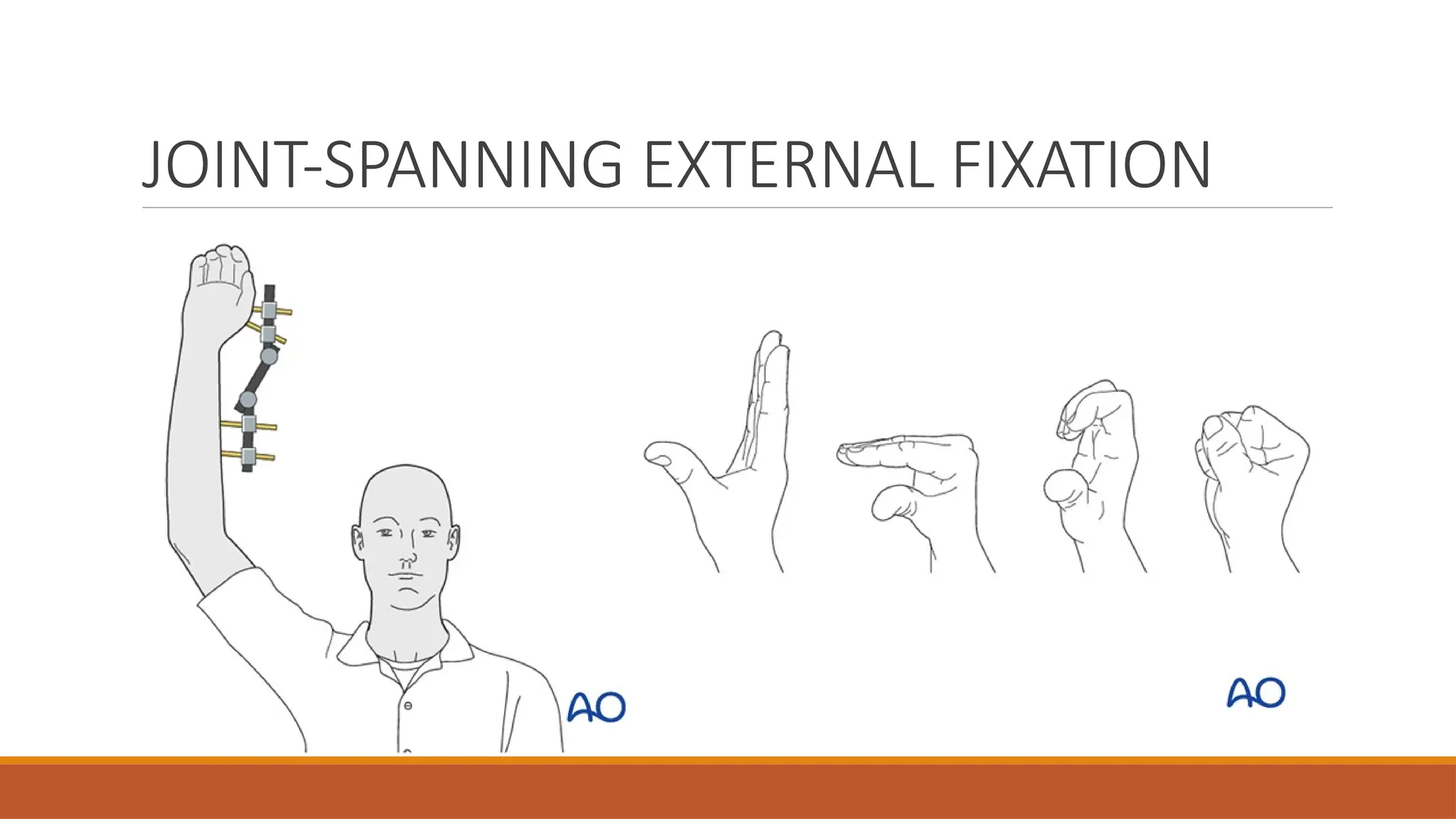 Fixation Methods and Implants for Distal Radius Fractures & Post-Op ...
