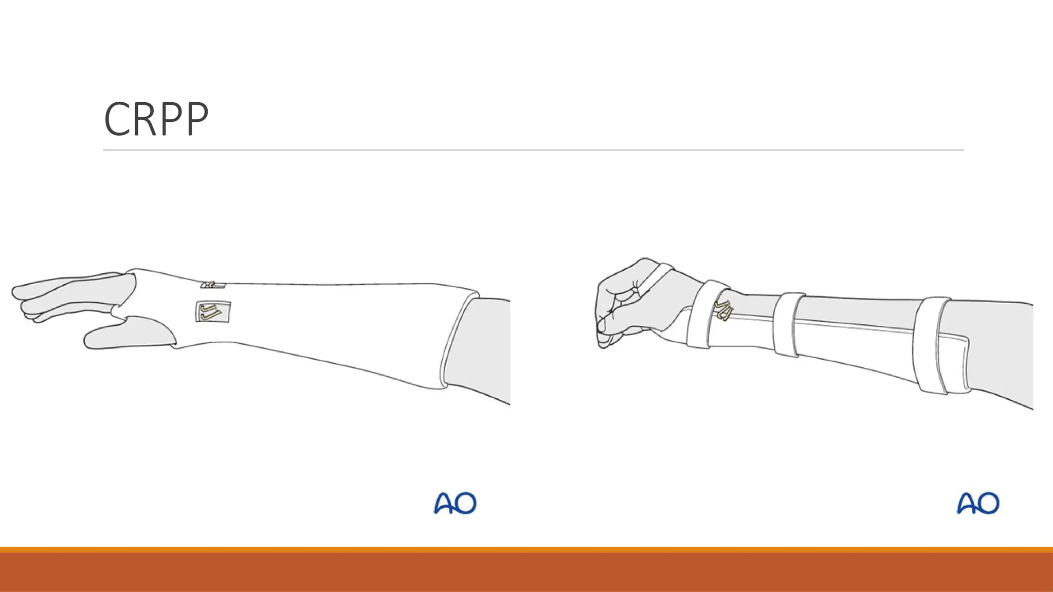 Fixation Methods and Implants for Distal Radius Fractures & Post-Op ...