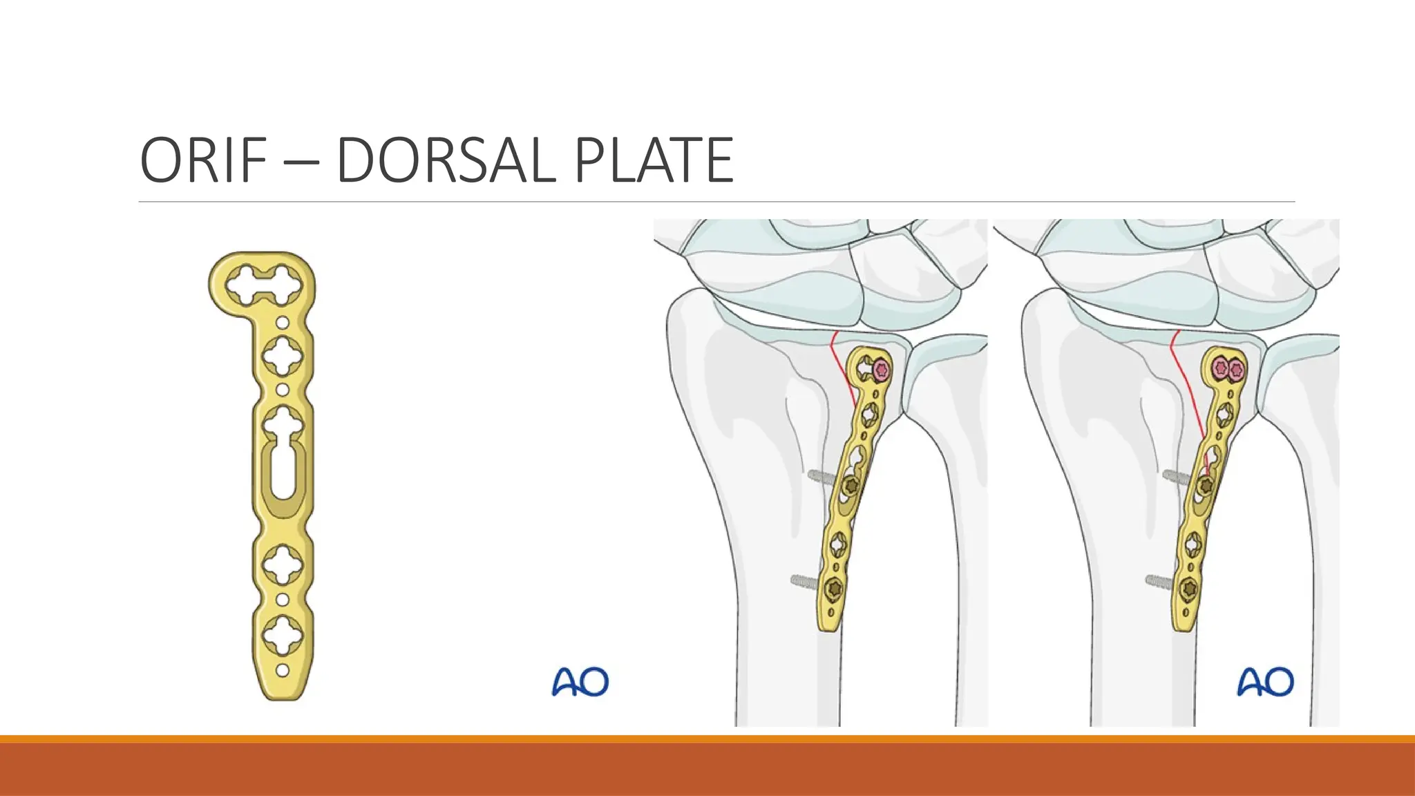 Fixation Methods and Implants for Distal Radius Fractures & Post-Op ...