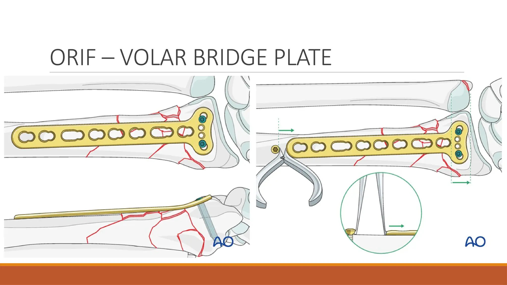 Fixation Methods and Implants for Distal Radius Fractures & Post-Op ...