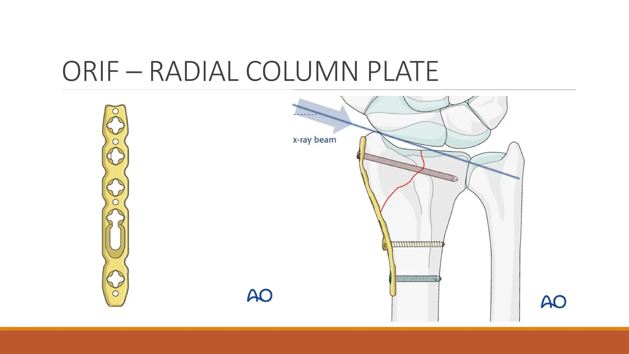 Fixation Methods and Implants for Distal Radius Fractures & Post-Op ...