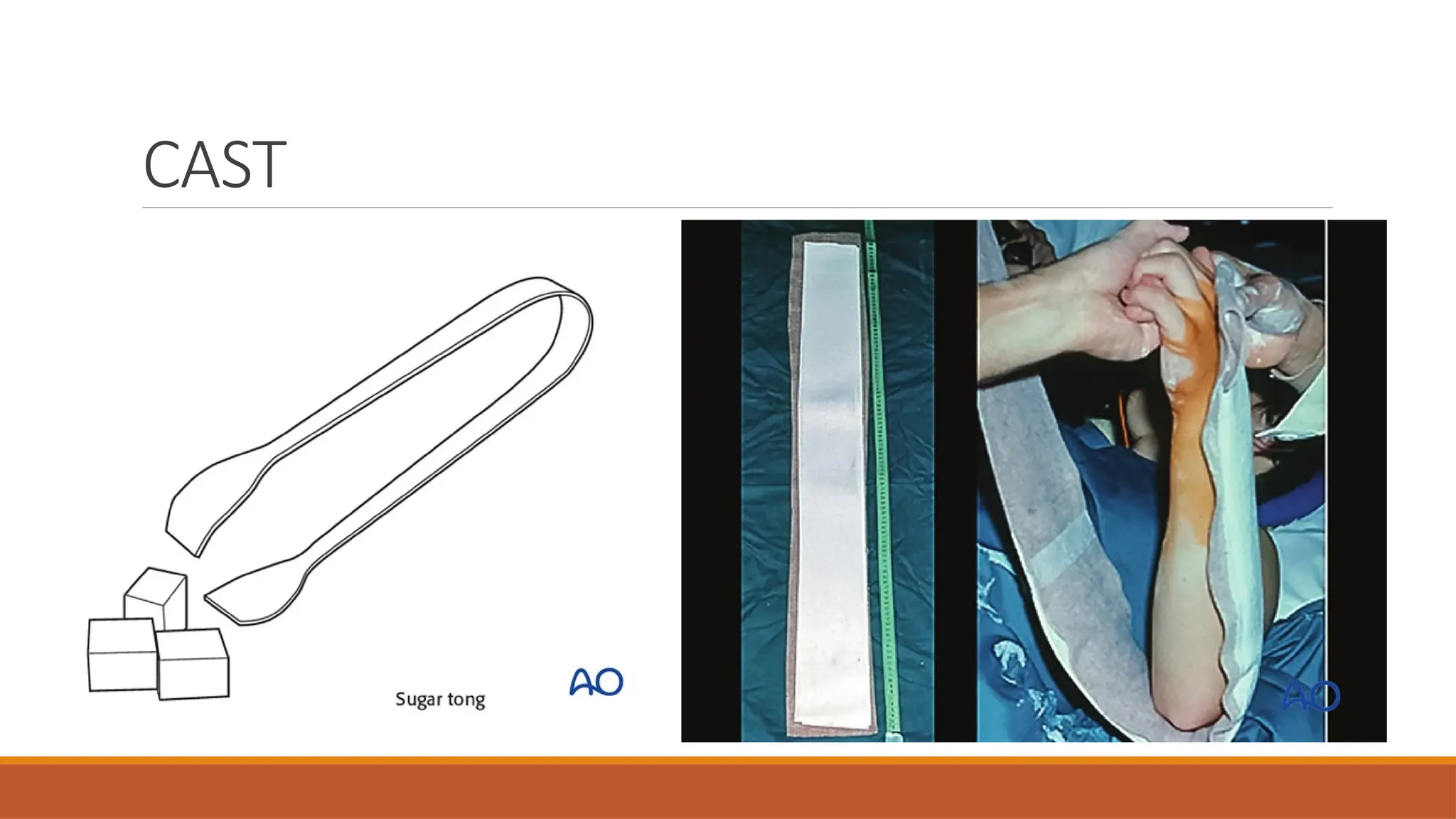 Fixation Methods and Implants for Distal Radius Fractures & Post-Op ...