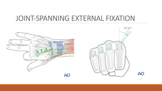 Fixation Methods and Implants for Distal Radius Fractures & Post-Op ...