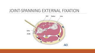 Fixation Methods and Implants for Distal Radius Fractures & Post-Op ...
