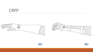 Fixation Methods and Implants for Distal Radius Fractures & Post-Op ...
