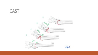 Fixation Methods and Implants for Distal Radius Fractures & Post-Op ...